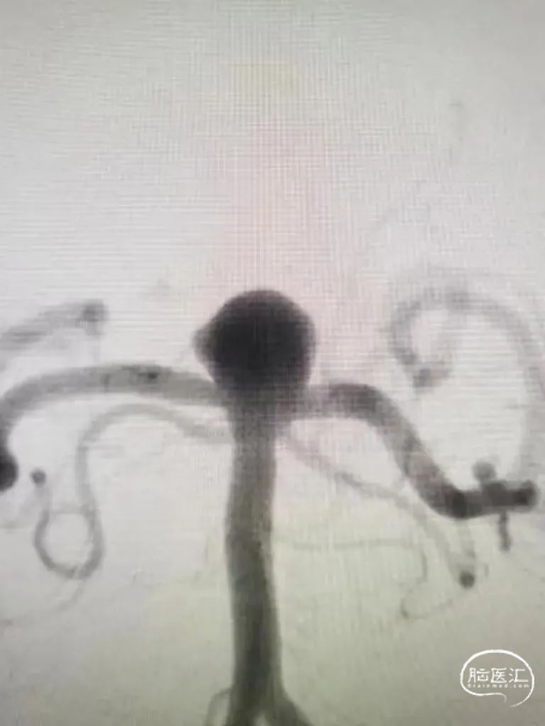 One And Done,一网无余丨胡骁教授:应用web™装置栓塞治疗基底动脉顶端动脉瘤一例 脑医汇 神外资讯 神介资讯