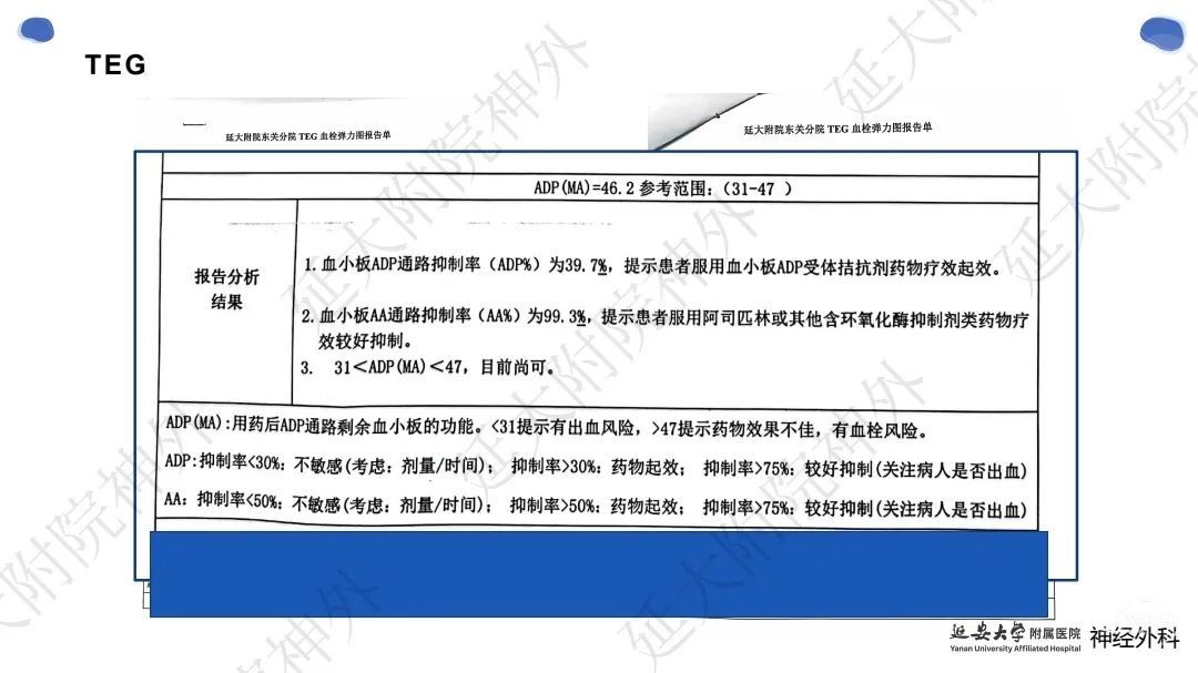 监测有道丨高龄、重症、高阿司匹林抑制率右侧基底节区脑出血患者神经内镜下血肿清除——颅脑创伤 神经重症周刊(第268期) 脑医汇