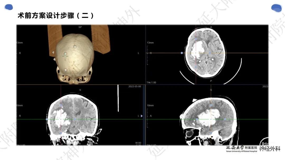 监测有道丨高龄、重症、高阿司匹林抑制率右侧基底节区脑出血患者神经内镜下血肿清除——颅脑创伤 神经重症周刊(第268期) 脑医汇
