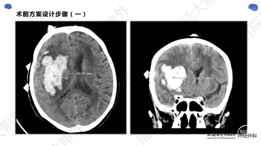 监测有道丨高龄、重症、高阿司匹林抑制率右侧基底节区脑出血患者神经内镜下血肿清除——颅脑创伤 神经重症周刊(第268期) 脑医汇