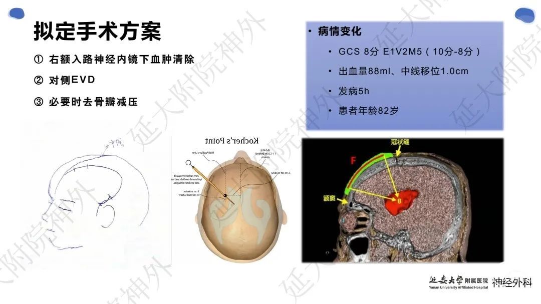 监测有道丨高龄、重症、高阿司匹林抑制率右侧基底节区脑出血患者神经内镜下血肿清除——颅脑创伤 神经重症周刊(第268期) 脑医汇