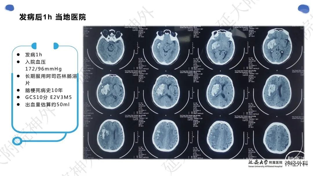 监测有道丨高龄、重症、高阿司匹林抑制率右侧基底节区脑出血患者神经内镜下血肿清除——颅脑创伤 神经重症周刊(第268期) 脑医汇