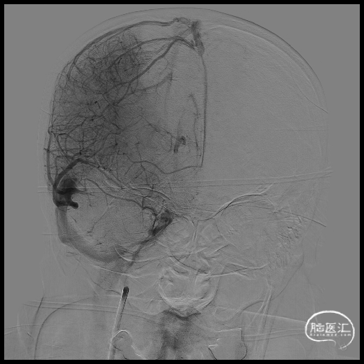 【禾锦囊】Afentta™抽吸导管助力大负荷血栓成功再通 - 脑医汇