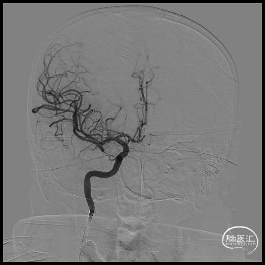 【禾锦囊】Afentta™抽吸导管助力大负荷血栓成功再通 - 脑医汇