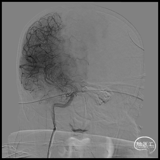 【禾锦囊】Afentta™抽吸导管助力大负荷血栓成功再通 - 脑医汇