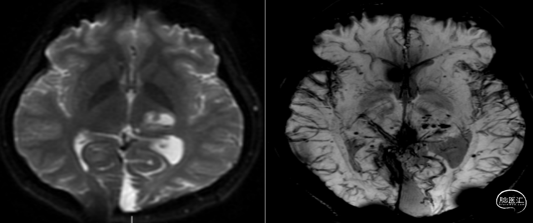 17岁男性，IDH野生型高级别胶质瘤患者放化疗联合TTFields治疗，病情持续稳定 - 脑医汇