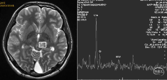 17岁男性，IDH野生型高级别胶质瘤患者放化疗联合TTFields治疗，病情持续稳定 - 脑医汇