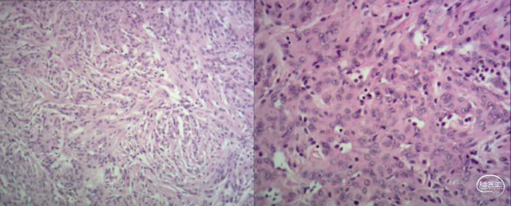 17岁男性，IDH野生型高级别胶质瘤患者放化疗联合TTFields治疗，病情持续稳定 - 脑医汇