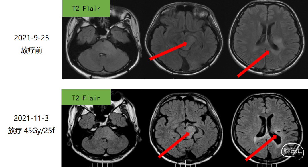 17岁男性，IDH野生型高级别胶质瘤患者放化疗联合TTFields治疗，病情持续稳定 - 脑医汇