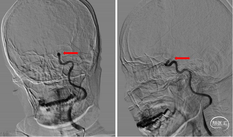 【沙场点兵 有史可鉴】AXS Catalyst 6+Trevo XP ProVue取栓一例 - 脑医汇