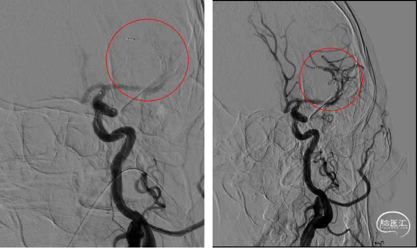 【沙场点兵 有史可鉴】AXS Catalyst 6+Trevo XP ProVue取栓一例 - 脑医汇