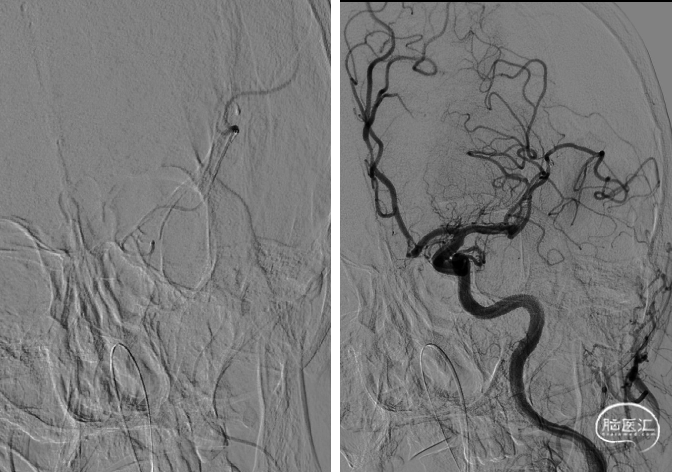 【沙场点兵 有史可鉴】AXS Catalyst 6+Trevo XP ProVue取栓一例 - 脑医汇