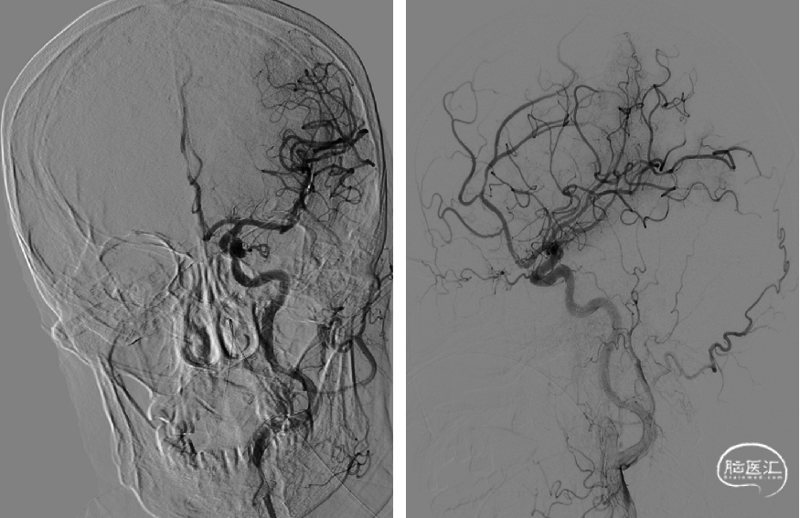 【沙场点兵 有史可鉴】AXS Catalyst 6+Trevo XP ProVue取栓一例 - 脑医汇