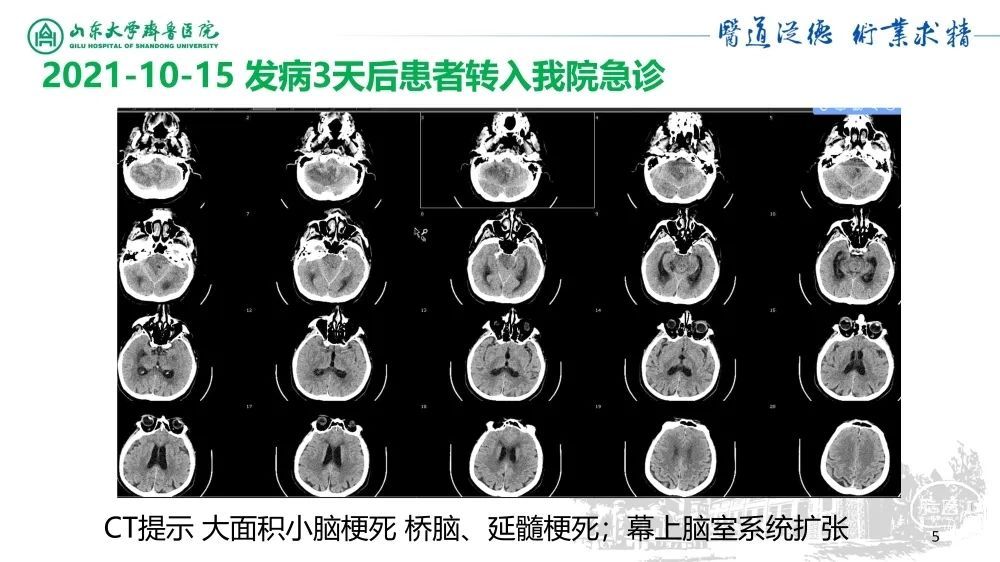 监测有道丨成功救治一例大面积小脑梗死合并重症肺炎、急性肾损伤患者——颅脑创伤 神经重症周刊(第274期) 脑医汇 神外资讯 神介资讯