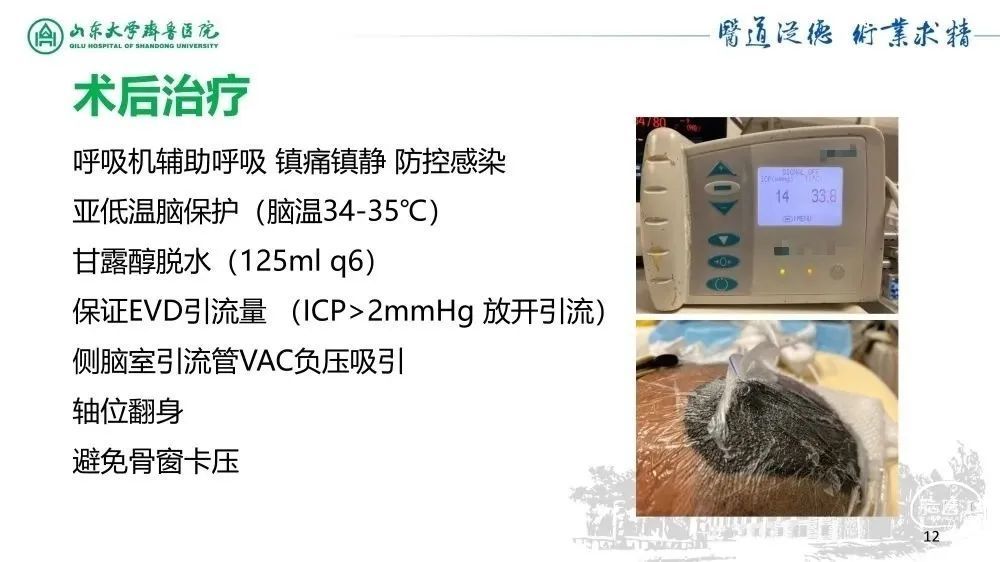 监测有道丨成功救治一例大面积小脑梗死合并重症肺炎、急性肾损伤患者——颅脑创伤 神经重症周刊（第274期） 脑医汇 神外资讯 神介资讯