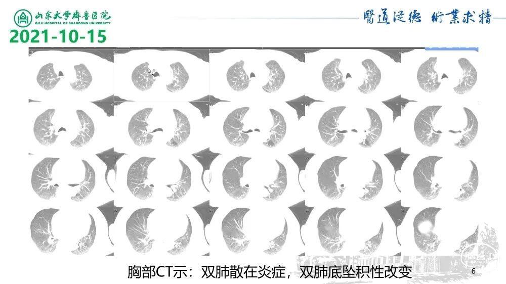 监测有道丨成功救治一例大面积小脑梗死合并重症肺炎、急性肾损伤患者——颅脑创伤 神经重症周刊(第274期) 脑医汇 神外资讯 神介资讯