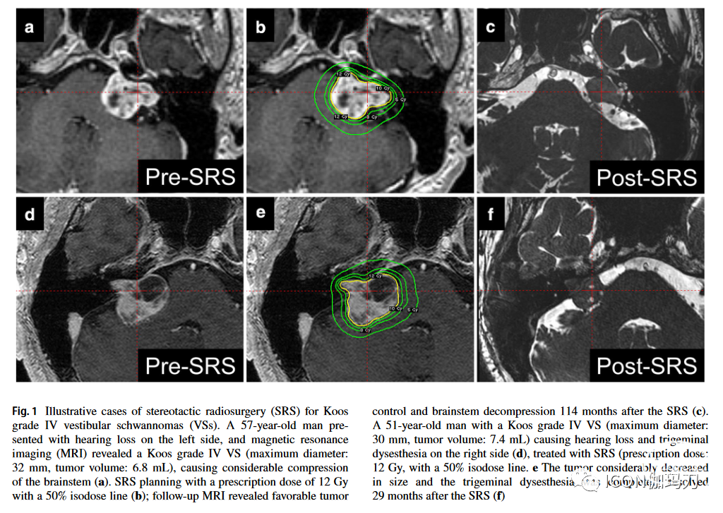 【文献快递】立体定向放射外科治疗确保Koos IV级前庭神经鞘瘤的有效和安全的长期控制:单中心、回顾性、队列研究 - 脑医汇
