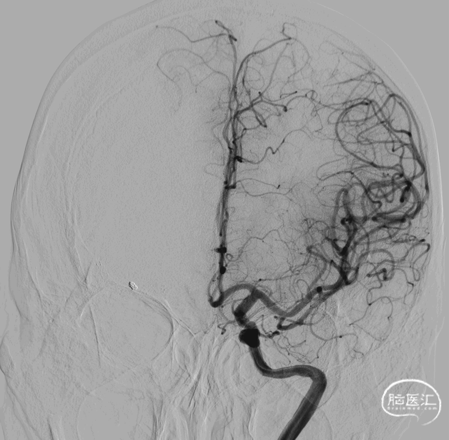 【卒中美谈】“以妙选，赢时间”React™ 71远端通路导管在院内卒中取栓的快速攻坚 - 脑医汇