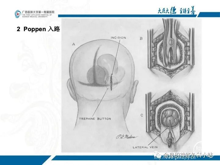 【课件分享】Poppen入路的学习与应用 - 脑医汇
