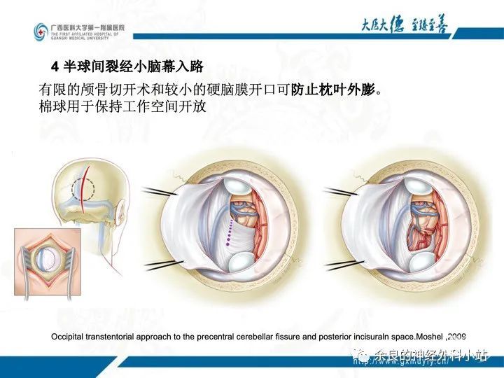 【课件分享】Poppen入路的学习与应用 - 脑医汇
