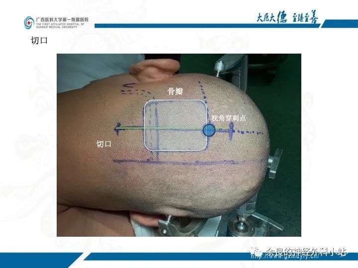 【课件分享】Poppen入路的学习与应用 - 脑医汇