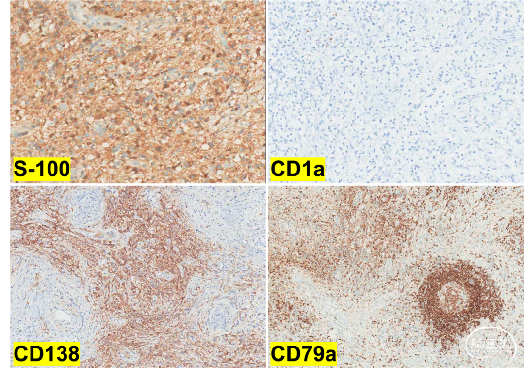 脑膜Rosai-Dorfman病一例（神经病理系列二十五）---浙二神外周刊（第363期） - 脑医汇