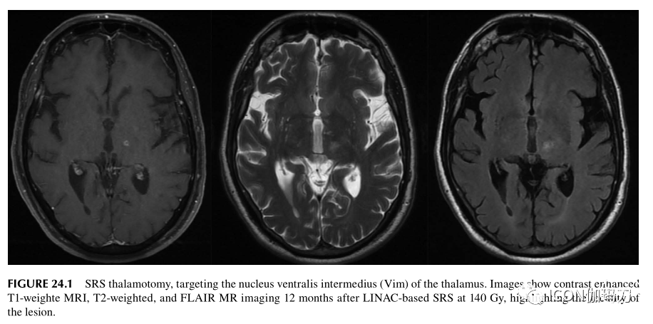 【笔记】放射外科治疗运动障碍 - 脑医汇 - 神外资讯 - 神介资讯