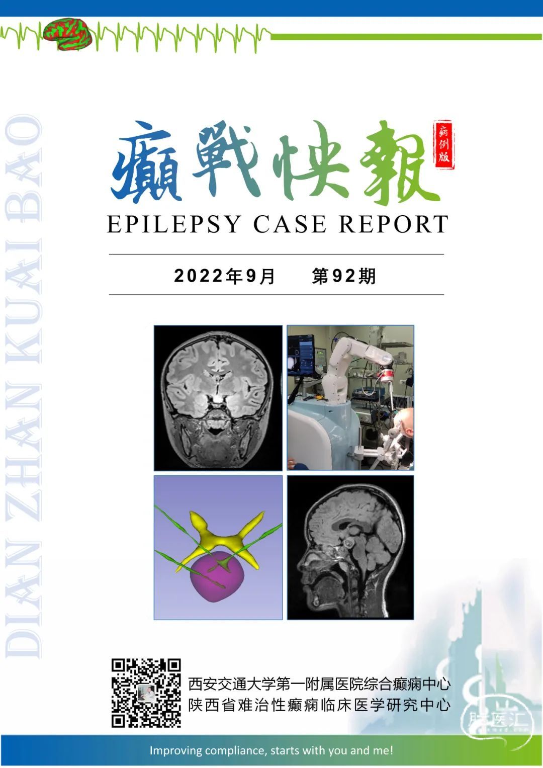 【癫战快报】第92期：SEEG引导下RF-TC治疗下丘脑错构瘤继发癫痫一例 - 脑医汇