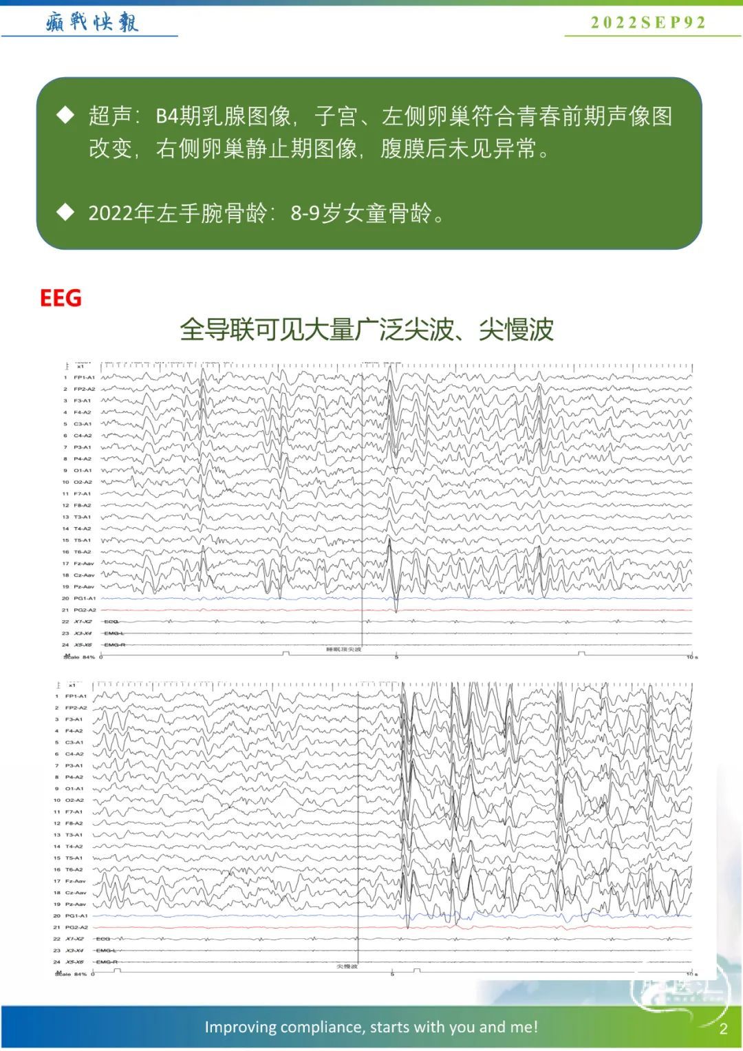 【癫战快报】第92期：SEEG引导下RF-TC治疗下丘脑错构瘤继发癫痫一例 - 脑医汇
