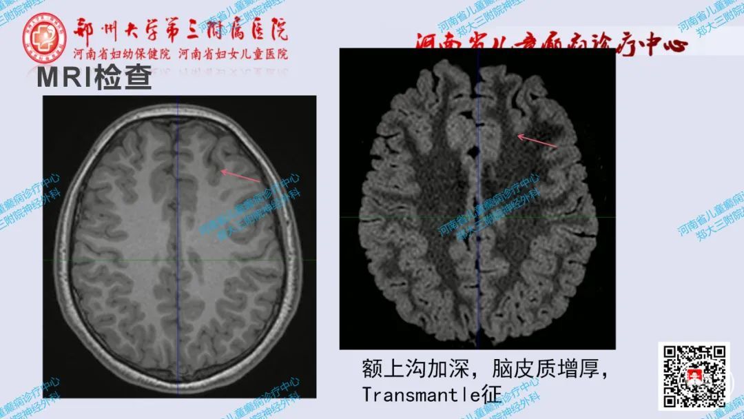 《术战癫峰》第67期：左额叶皮层发育不良（Transmantle征）手术切除一例 - 脑医汇