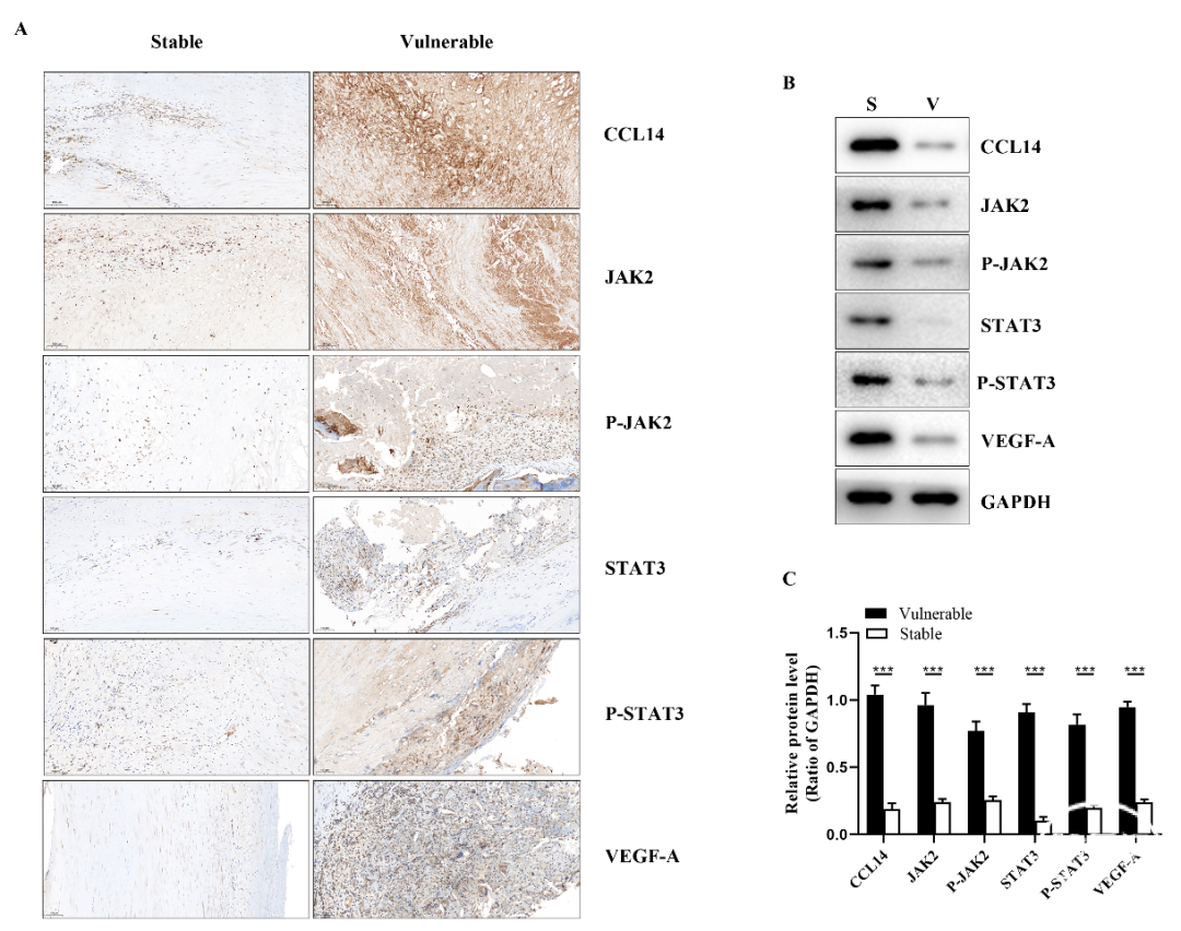 【中国声音】CCL14通过促进人类颈动脉斑块的新生血管而加剧斑块内的脆弱性 - 脑医汇