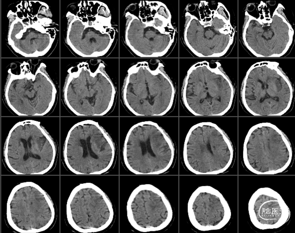 发病时间不明AIS治疗一例并文献复习 - 脑医汇