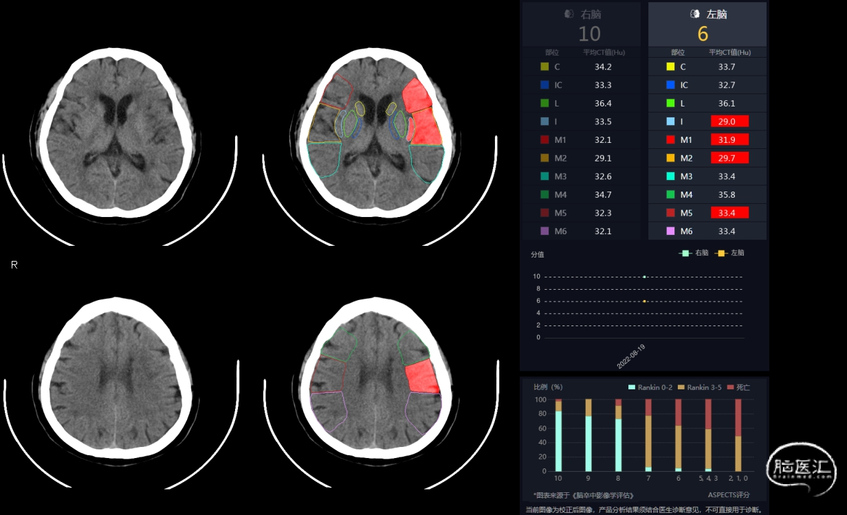 发病时间不明AIS治疗一例并文献复习 - 脑医汇