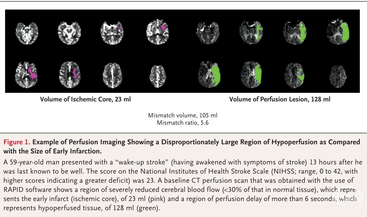发病时间不明AIS治疗一例并文献复习 - 脑医汇