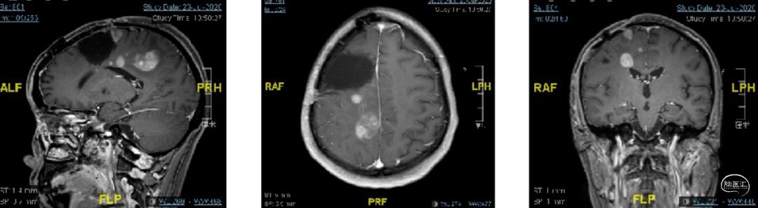 复发H3 G34突变型高级别胶质瘤电场治疗一例 - 脑医汇