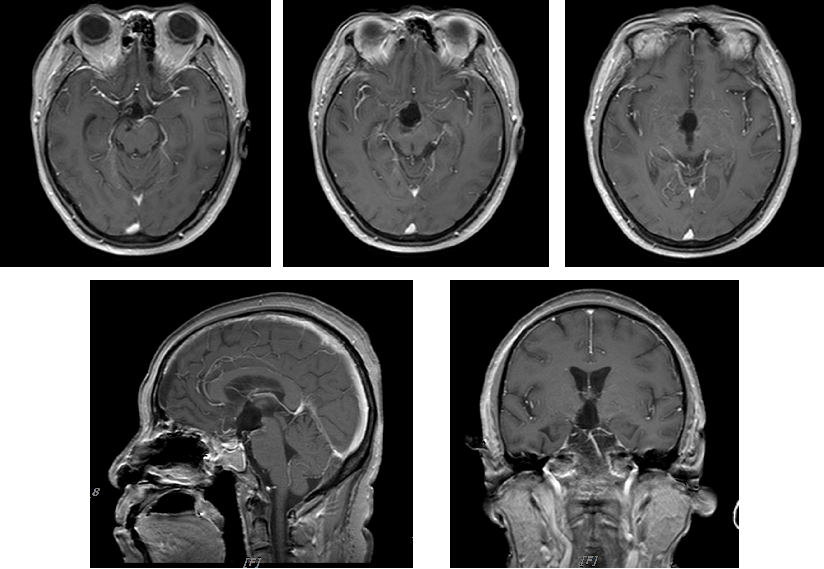 神经内镜下经右侧单鼻孔-蝶窦入路脑干血管瘤切除术 - 脑医汇