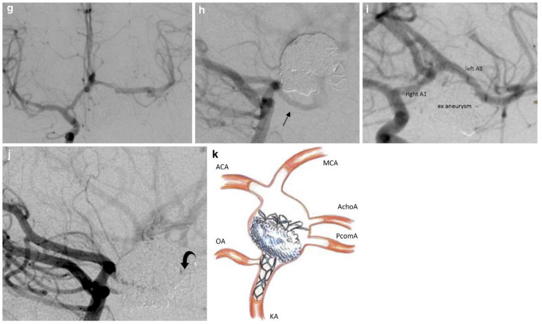 应用pCONUS闭塞载瘤动脉治疗复杂动脉瘤时对远端动脉的保护——病例报道研究 - 脑医汇