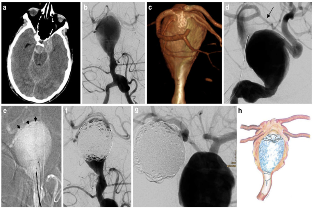 应用pCONUS闭塞载瘤动脉治疗复杂动脉瘤时对远端动脉的保护——病例报道研究 - 脑医汇