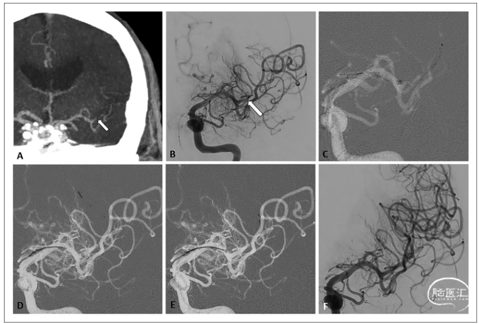 使用Nimbus取栓支架进行机械取栓——单中心观察研究的初步经验 - 脑医汇