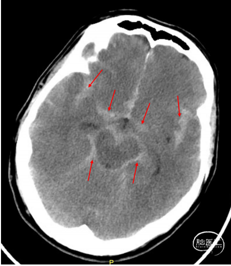 蛛网膜下腔出血的急诊管理策略 - 脑医汇 - 神外资讯 - 神介资讯