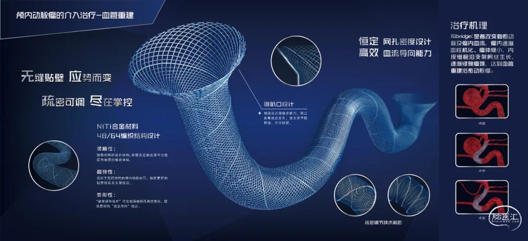 「“术”说卒中」第33期丨翻山越岭 终显神通——Tubridge®翻山治疗椎动脉复杂夹层动脉瘤 - 脑医汇