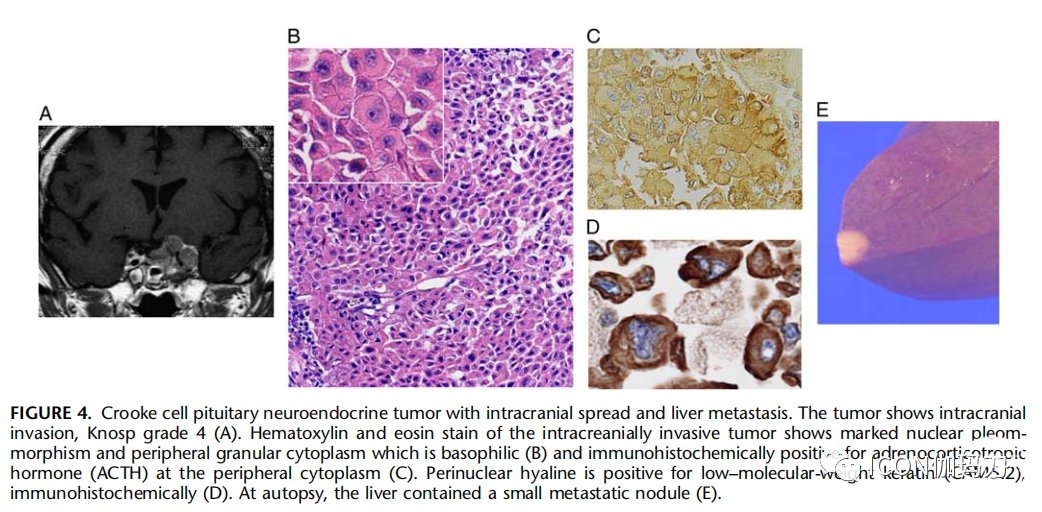 【综述】人类垂体中Croooke细胞的病理学 - 脑医汇