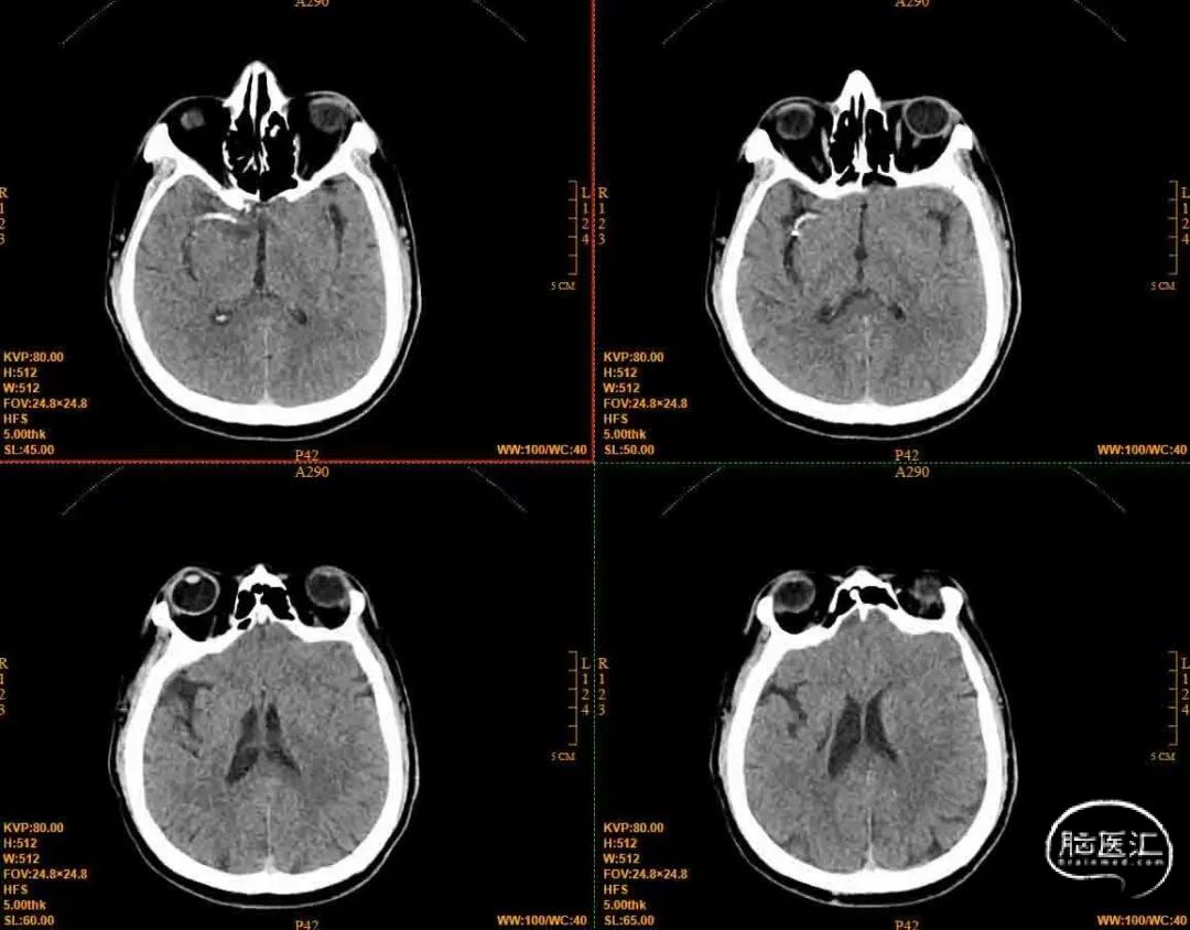 【病例夹】Atlas支架治疗大脑中动脉闭塞一例汇报 - 脑医汇