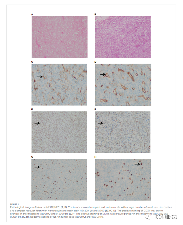 【文献摘要】颅内孤立性纤维性肿瘤/血管外皮细胞瘤:术后放疗技术的作用和选择 - 脑医汇