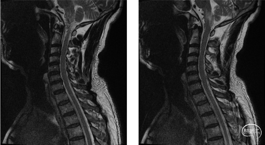 温医一院神经外科病例分享（16）：颅颈交界DAVF切除术1例 - 脑医汇