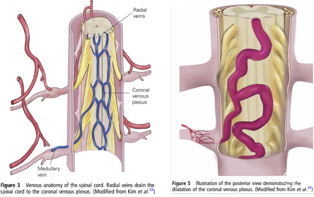 温医一院神经外科病例分享（16）：颅颈交界DAVF切除术1例 - 脑医汇