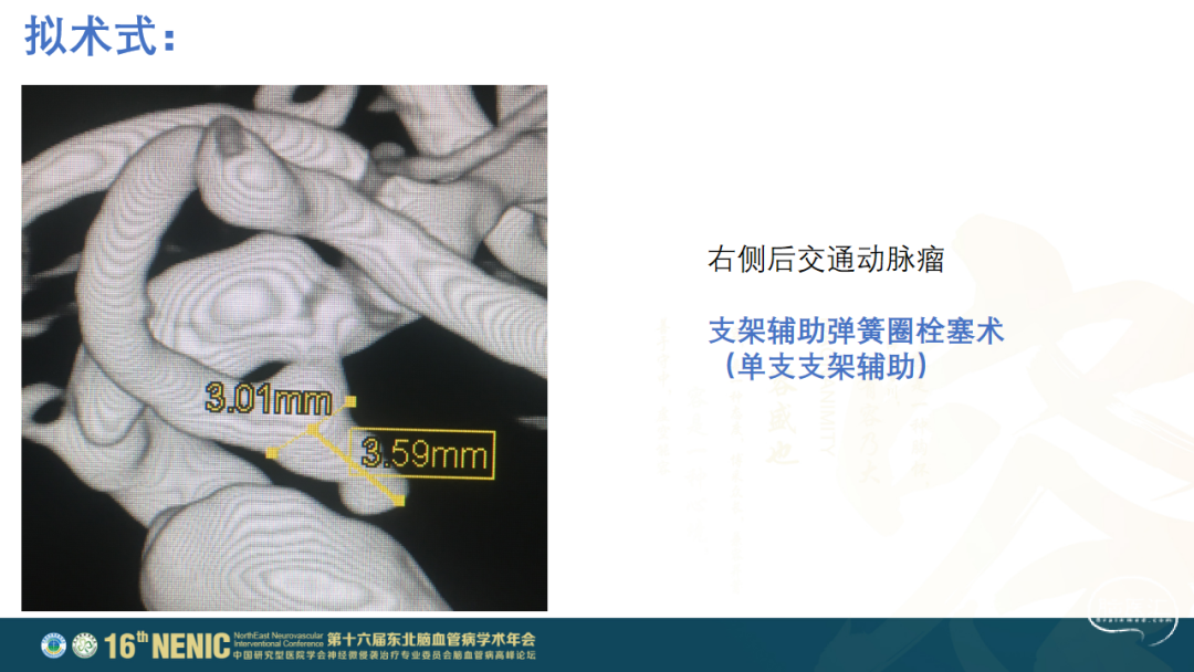 【Day3-今日09:00手术直播】第十六届东北脑血管病学术年会-中国研究型医院学会神经微侵袭治疗专业委员会脑血管病高峰论坛 - 脑医汇 ...