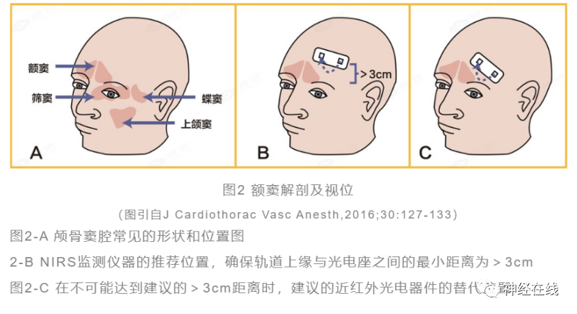 颈动脉内膜切除术（CEA）学习笔记连载二（过程1） - 脑医汇