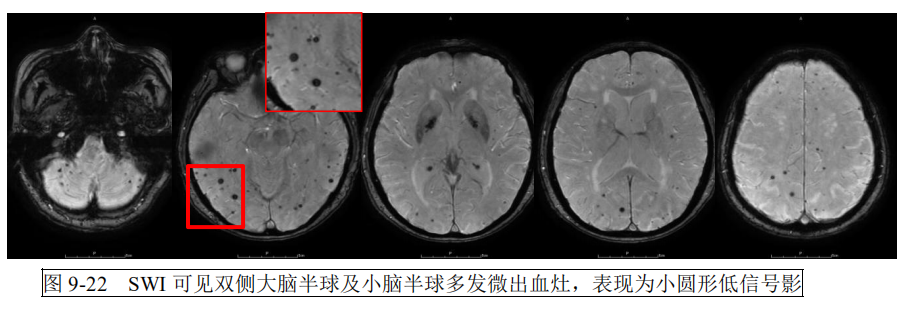 规范学习系列：中国脑血管病影像学指导规范⑧脑小血管病影像学指导规范（2021） - 脑医汇