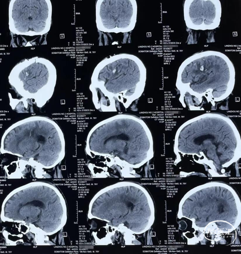 中央区脑出血小骨窗开颅经额下沟神经内镜下血肿清除术 - 脑医汇